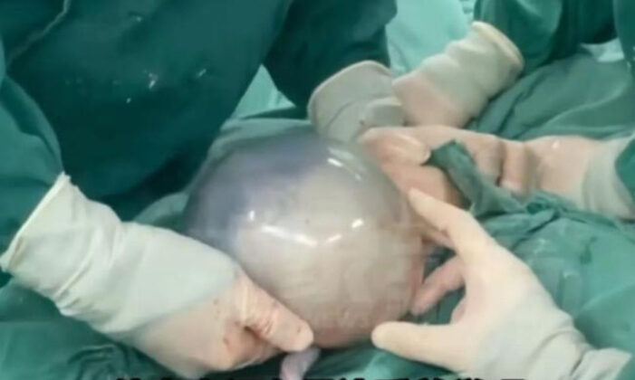 Baby Born in a Shell in Xuzhou Lifts Veil of Nature; Doctors in Tears ...